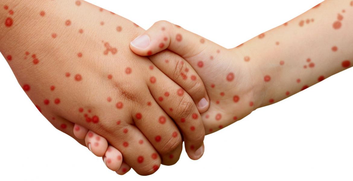 Measles Outbreak Reported in West Texas County